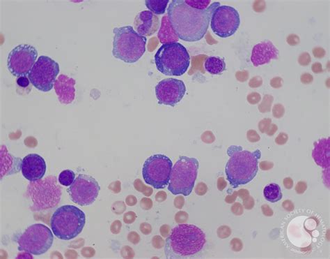 Bone Marrow Aspirate 2