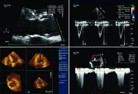 Quantitation Of Mitral Regurgitation Circulation
