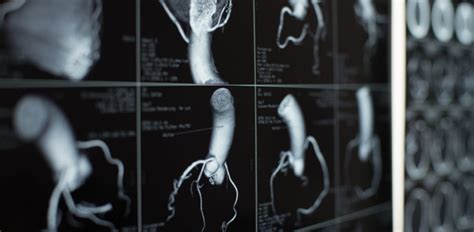 Antithrombotic Therapy Shows Similar Results By Sex Conexiant