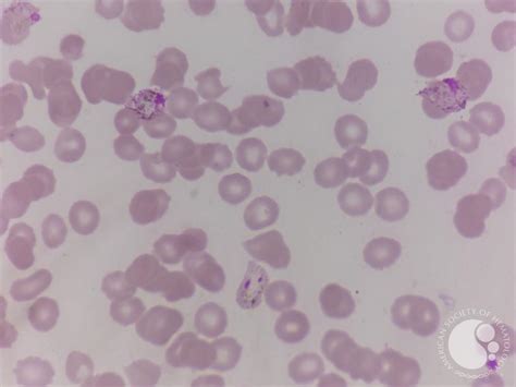 Plasmodium Vivax