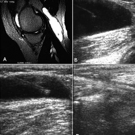 Anterior Approach To Shoulder Arthrogram Performed With The Patient In