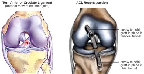 ACL Reconstruction Canberra Orthopaedics