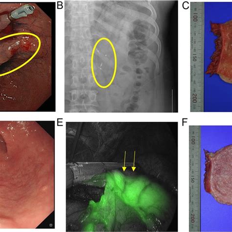 Surgical Procedure For Proximal Margin Resection During Download Scientific Diagram