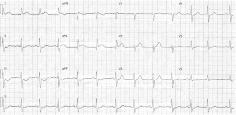Ecg Case 307 Manual Of Medicine