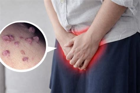 Kondiloma Akuminata Pada Wanita Inilah Berbagai Informasi Yang Perlu