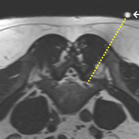 Axial T2 Weighted Mri Image Of 43 Year Old Man With Suspected Left L5