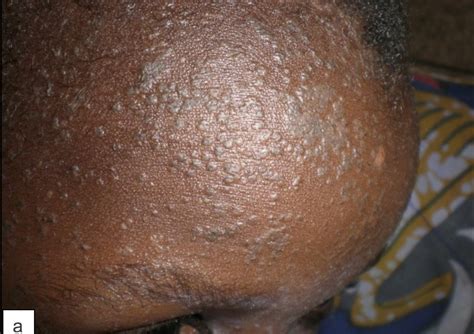 What Does Flat Genital Warts Look Like At Jessie Nassar Blog