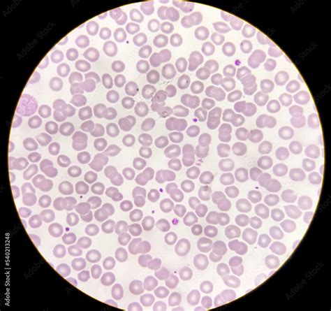 Microscopic View Of Hematological Stained Slide Thrombocytopenia
