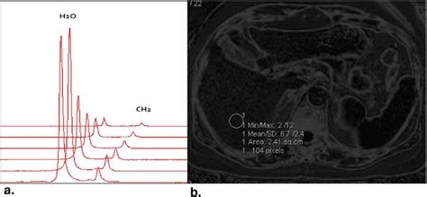 A 1 H Magnetic Resonance Spectra And B Liver Fat Fraction Mapping Download Scientific