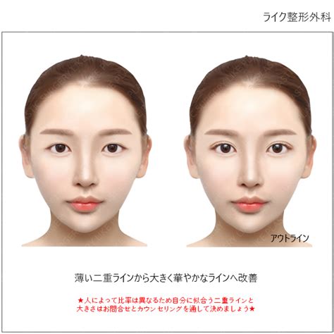 目 大きく する 整形