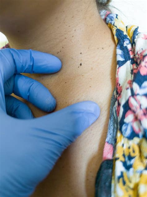 Treatment Warts On The Neck Of A Woman Unrecognizable Doctor Examines