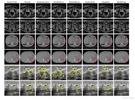 【医学图像数据增强】 Emit Diff:扩散模型 文本和结构引导,生成多样化且结构准确的医学图像51cto博客图像扩散算法 【医学图像数据增强】 Emit Diff:扩散模型 文本和结构引导,生成多样化且结构准确的医学图像51cto博客图像扩散算法