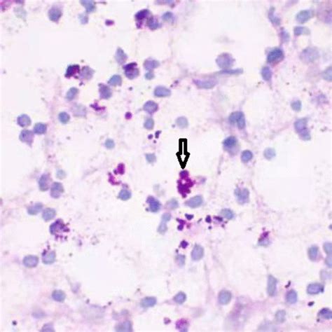 Pathological Examination Of Subcutaneous Nodules Indicate That Download Scientific Diagram