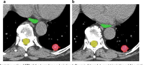 Figure 2 From Lung Cancer Dose Planning Esophagus And Spinal Cord Motion Relative To Gtv Motion