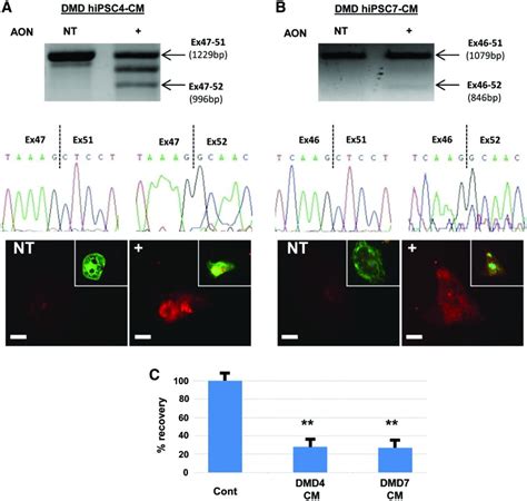 Exon Skipping And Gene Transfer Restore Dystrophin Expression In Human