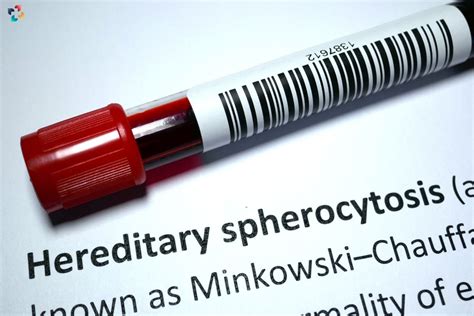 Mysteries Of Posterior Cortical Atrophy Symptoms Causes And