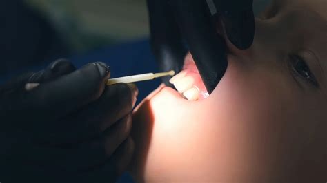 Using Silver Diamine Fluoride Sdf In Dental Hygiene Ohwrc