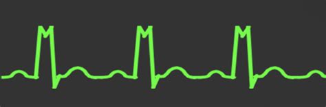Iabp Flashcards Quizlet