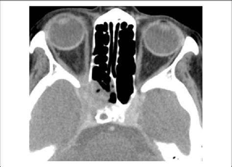 The Ethmoid Sinusitis In Computed Tomography Ct Scan Of One Patient