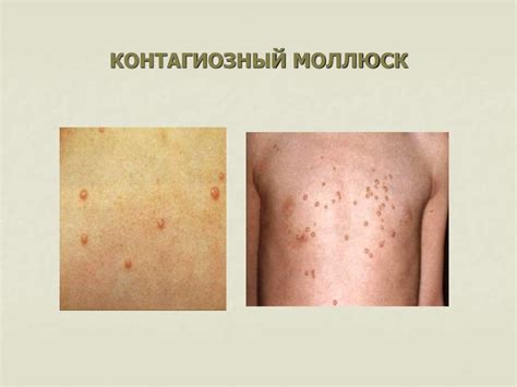 Паразитарные и вирусные заболевания кожи Занятие №6 презентация онлайн