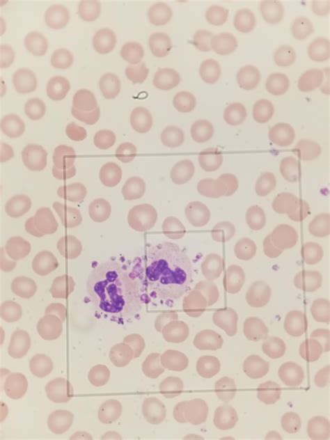 Rare Edta Phenomenon Known As Platelet Satellitism Rmedlabprofessionals