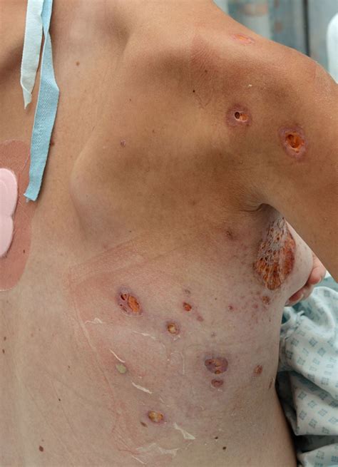 Pyoderma Gangrenosum Ibd