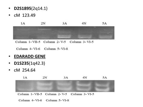 Ectodermal Dysplasias Genetic Disorder Pptx Skin And Dermatology Diseases And Conditions
