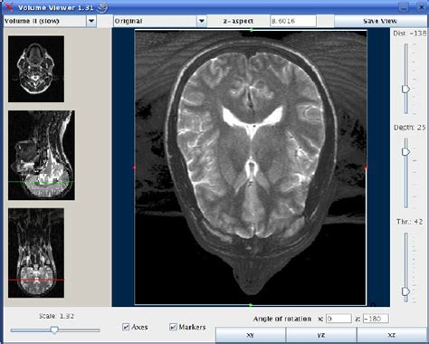 Imagej Application Displaying Overhead View Of Mri Of The Head And Neck