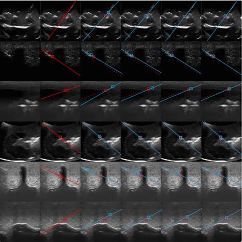 needle shaft and tip localization in 2d us sequences using the nyolo