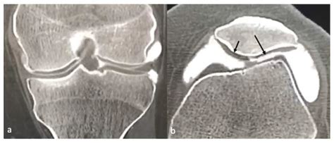 Life | Free Full-Text | Imaging of Cartilage and Chondral Defects: An ...