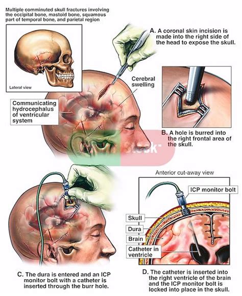 Brain Surgery Ventriculostomy And Placement Of Intracranial Pressure Icp Monitor Bolt