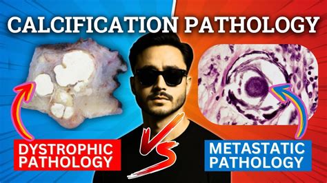 Calcification Pathology Dystrophic And Metastatic Calcification Pathology Calcium