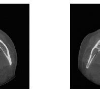 Illustration Of Two Types Of Abnormality A Close Border Lesion B Download Scientific
