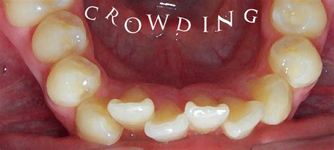 Tooth Extraction Pinnacle Dental Group