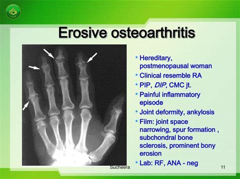 PPT Osteoarthritis And Exercise PowerPoint Presentation ID