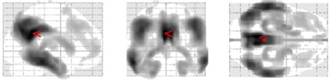 Sample Output Of Spm12 A Group Wise Comparison Was Performed On