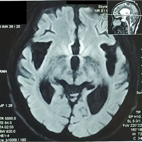 Bifrontal Temporal Atrophy Download Scientific Diagram