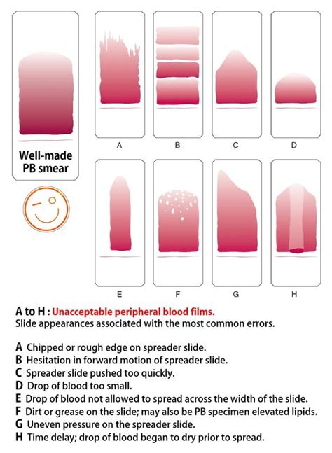 말초혈액도말 및 혈구형태 검사 네이버 블로그