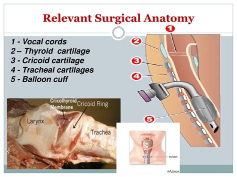 Ppt Tracheostomy Life Saving Procedure Powerpoint Presentation Free Download Id 9591293