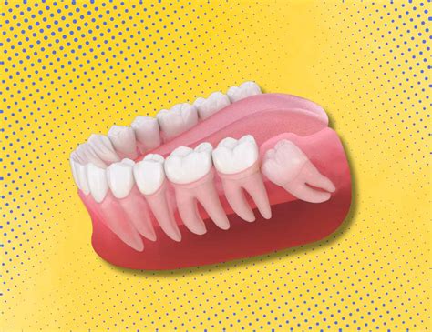 Why Are They Called Wisdom Teeth Everything Toronto Dental Clinic
