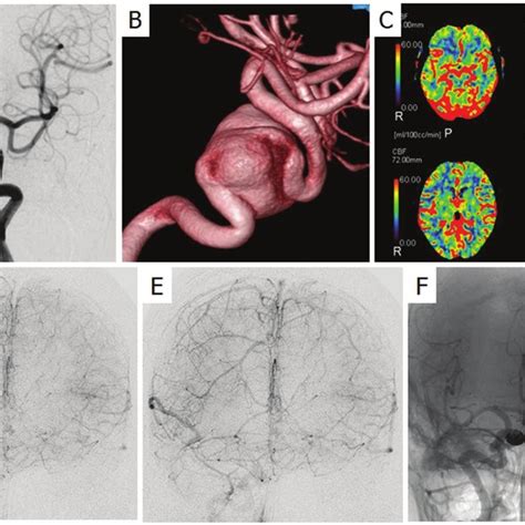 Pdf Multimodal Assessment For Balloon Test Occlusion Of The Internal