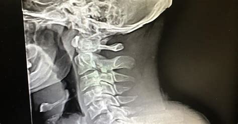 Chiropractor Wants To Charge Me 420 To Fix Alignment Issue Legit Or