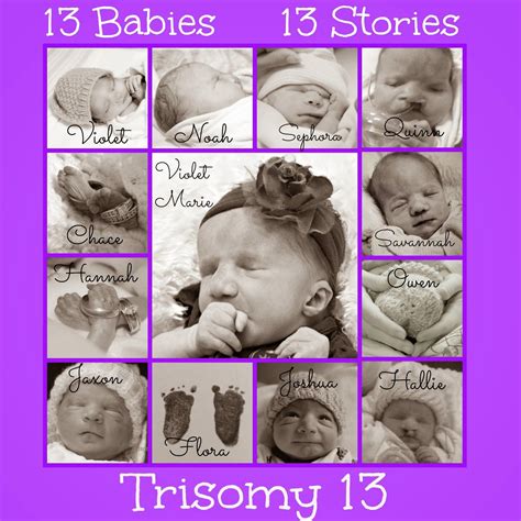 Trisomy 13 13 Babies 13 Stories