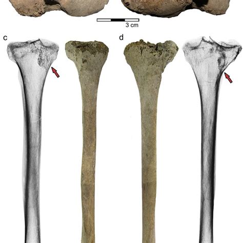 Comparison Between The Right Tibia Left Column And The Left Tibia Download Scientific Diagram