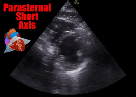 Regional Wall Motion Abnormality Searcy Em