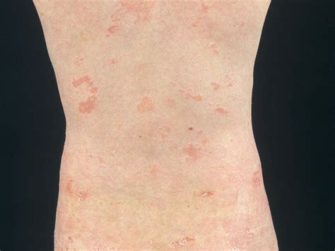 Erythrokeratodermia Variabilis