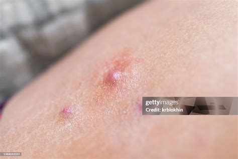 Macro Closeup Of Red Swollen Boil Pimple On Leg Skin Of Female Woman Showing Medical Condition