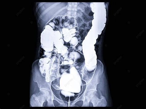 Barium Enema Contrastfilled Large Bowel Under Fluoroscopy Fluoroscopic