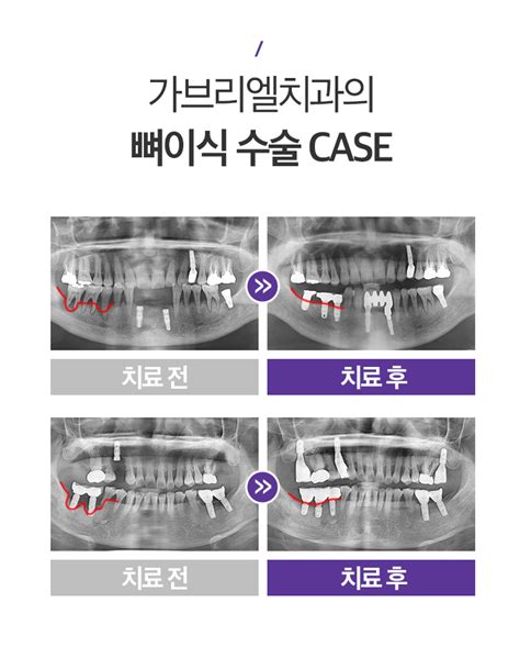 뼈이식 임플란트 가브리엘치과