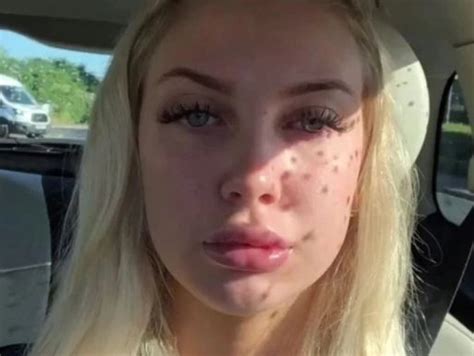 Mulher fica lábio deformado após preenchimento labial se mover FOLHAMAX